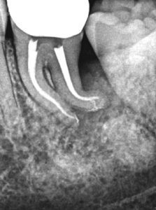 Mandibular molar with severely dilacerated root – Root Canal Specialty ...