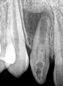 Maxillary lateral incisor with dens in dente – Root Canal Specialty ...