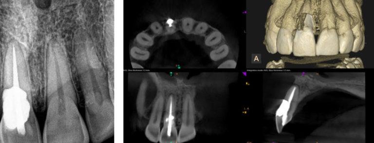 Conservative Endodontic Treatment for Cervical Invasive Resorption ...