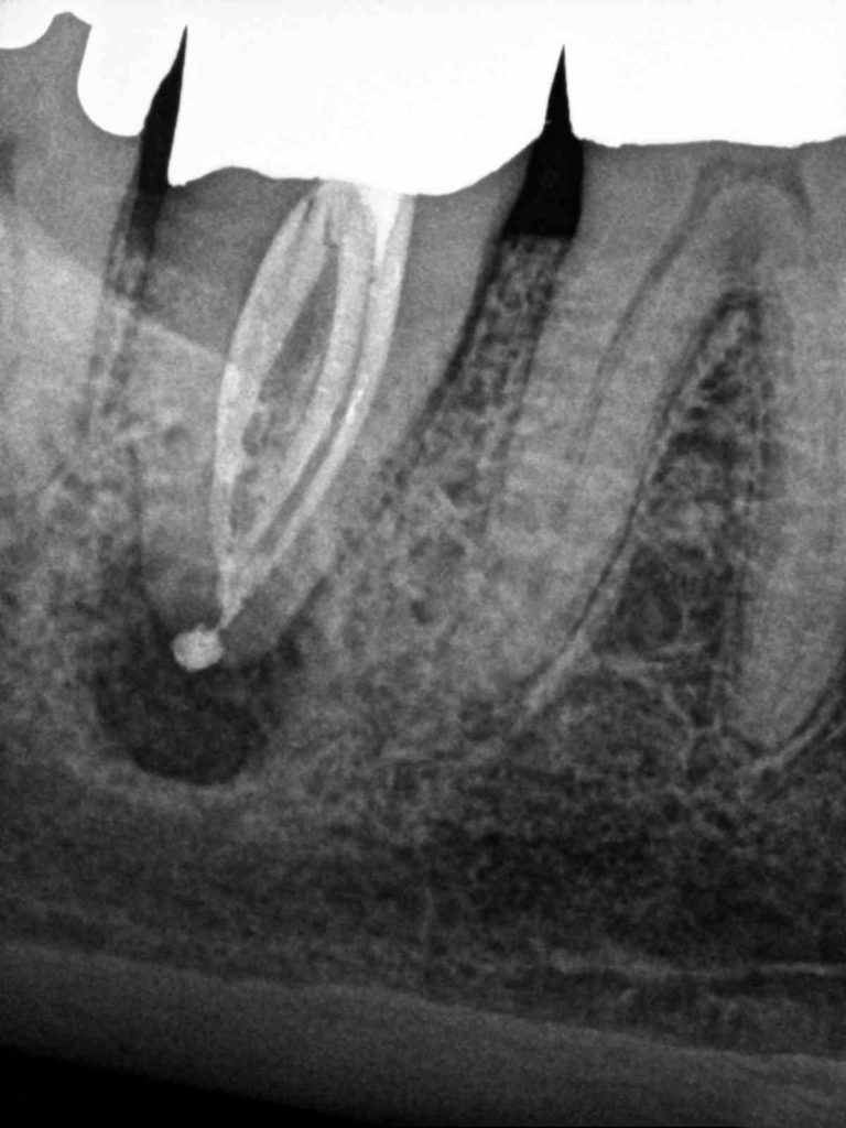Mandibular molar with “C” shaped canal – Root Canal Specialty Associates