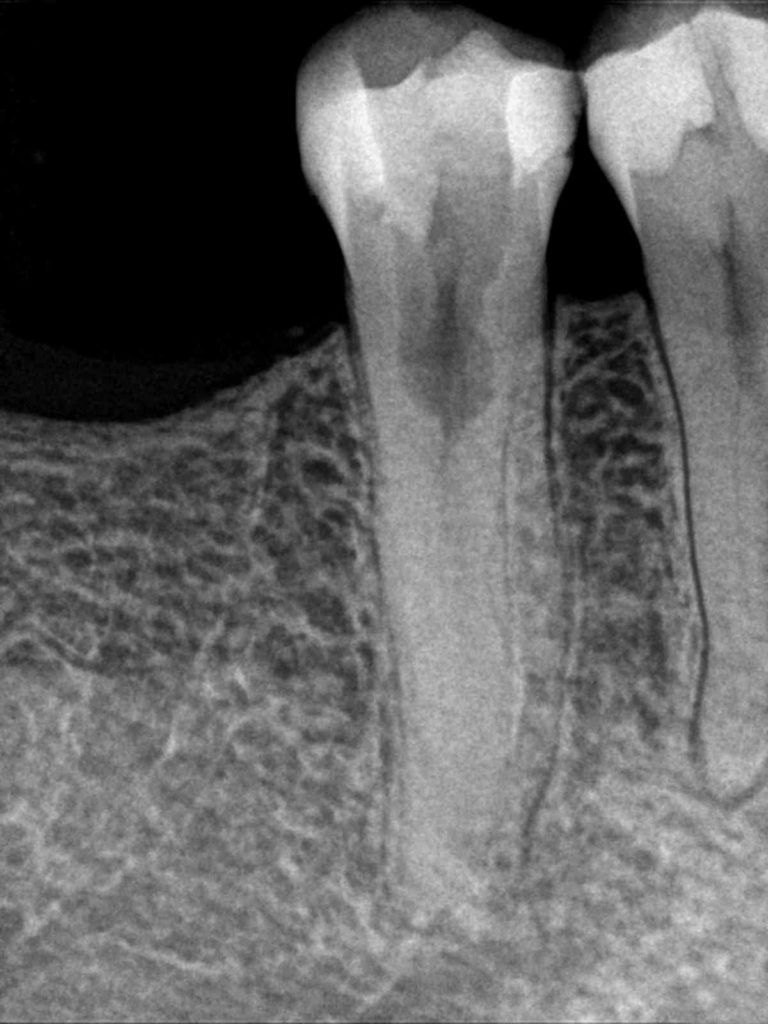 Mandibular bicuspid with aberrant anatomy – Root Canal Specialty Associates