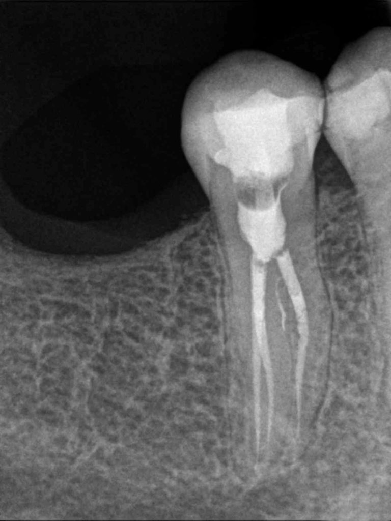 Mandibular bicuspid with aberrant anatomy – Root Canal Specialty Associates
