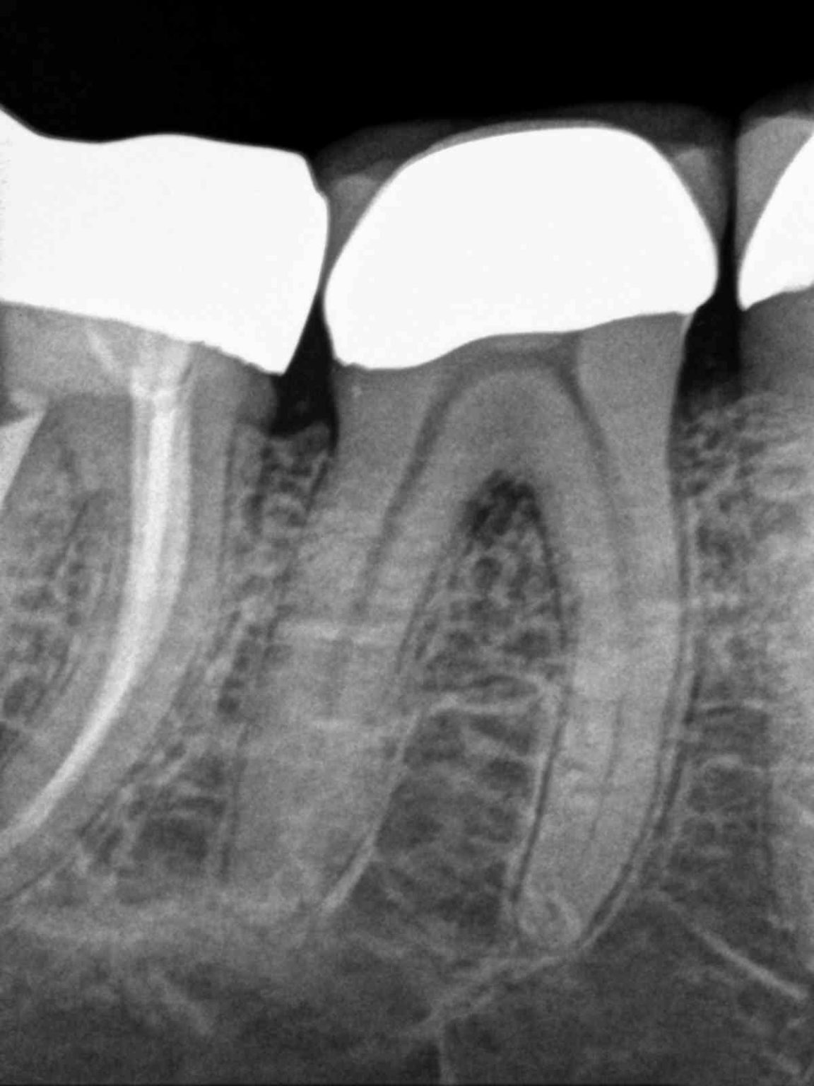 Mandibular molar with canal anastomosis and multiple portals of exit ...