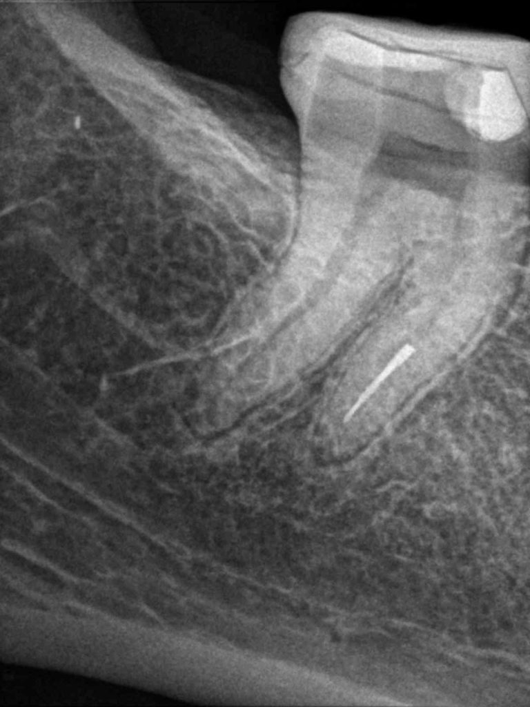 Mandibular molar with separated instrument – Root Canal Specialty ...