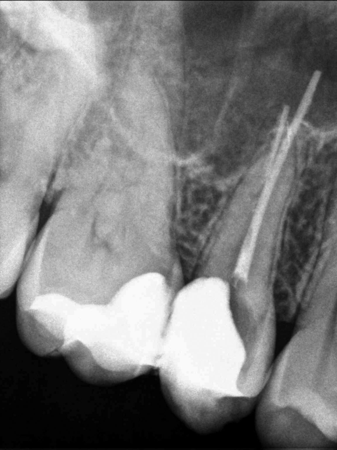 Endodontic retreatment of a maxillary second bicuspid with overextended ...