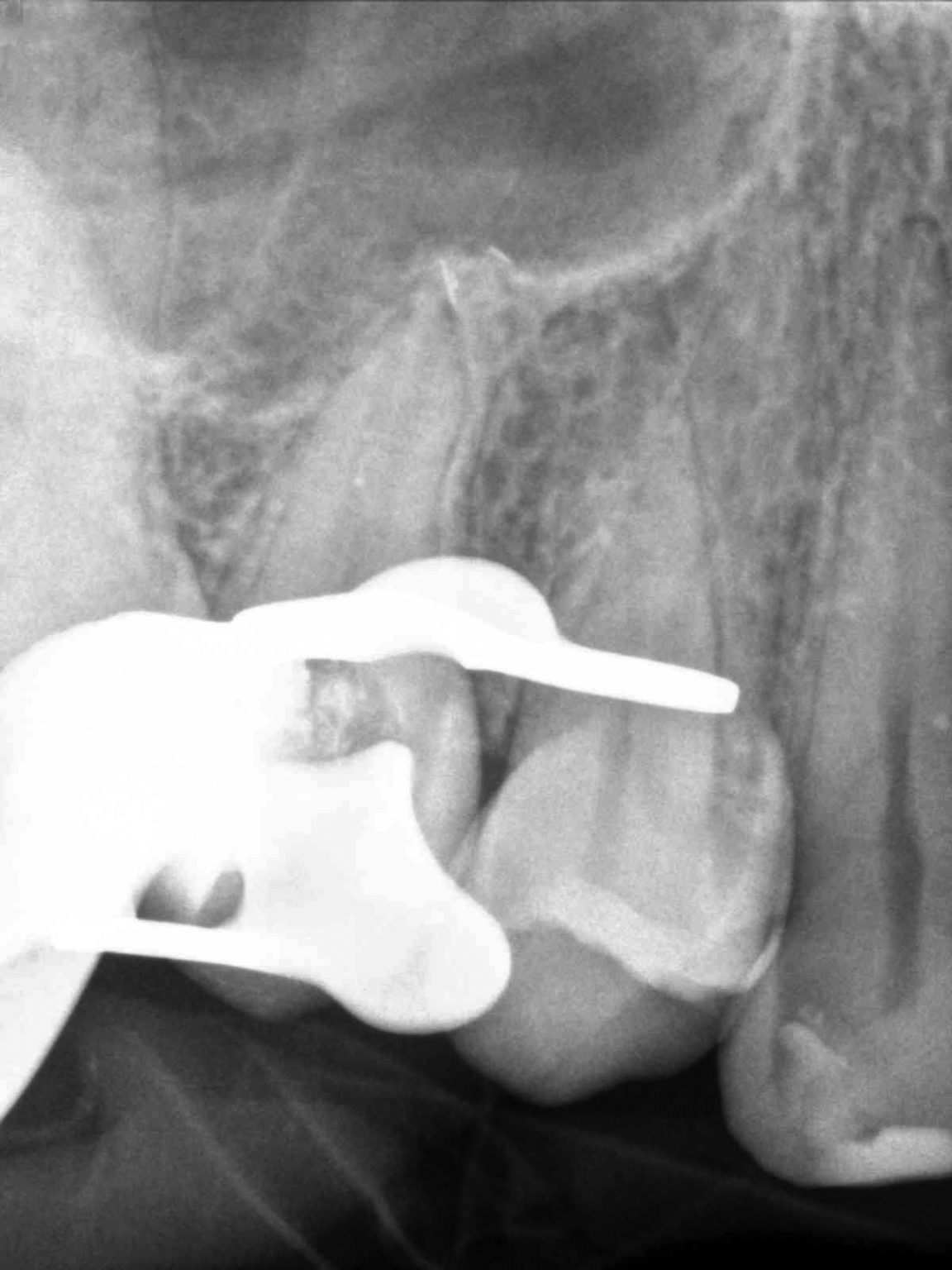 Endodontic retreatment of a maxillary second bicuspid with overextended ...