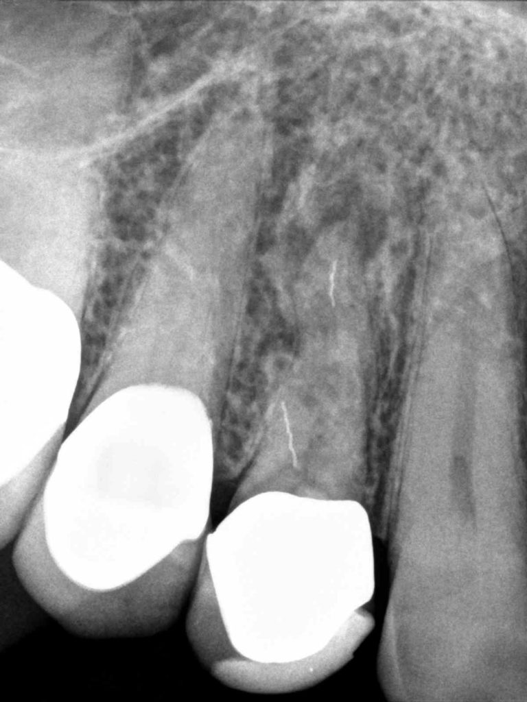 Endodontic retreatment with atypical anatomy and previously separated ...