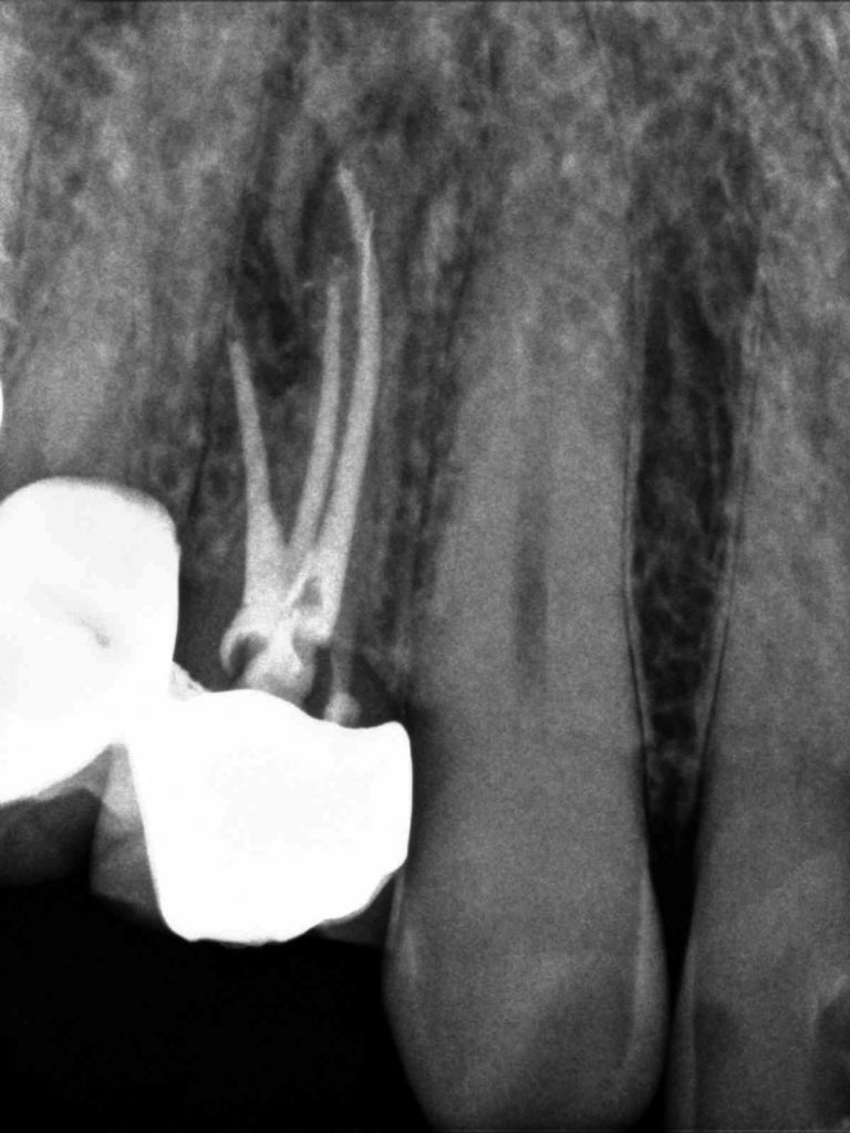 Endodontic retreatment with atypical anatomy and previously separated ...