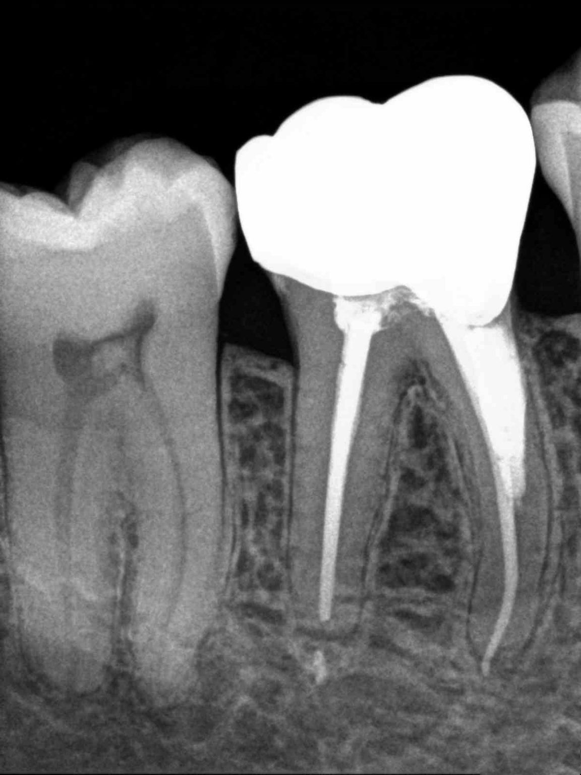 Conventional endodontic treatment with surgical repair of external ...