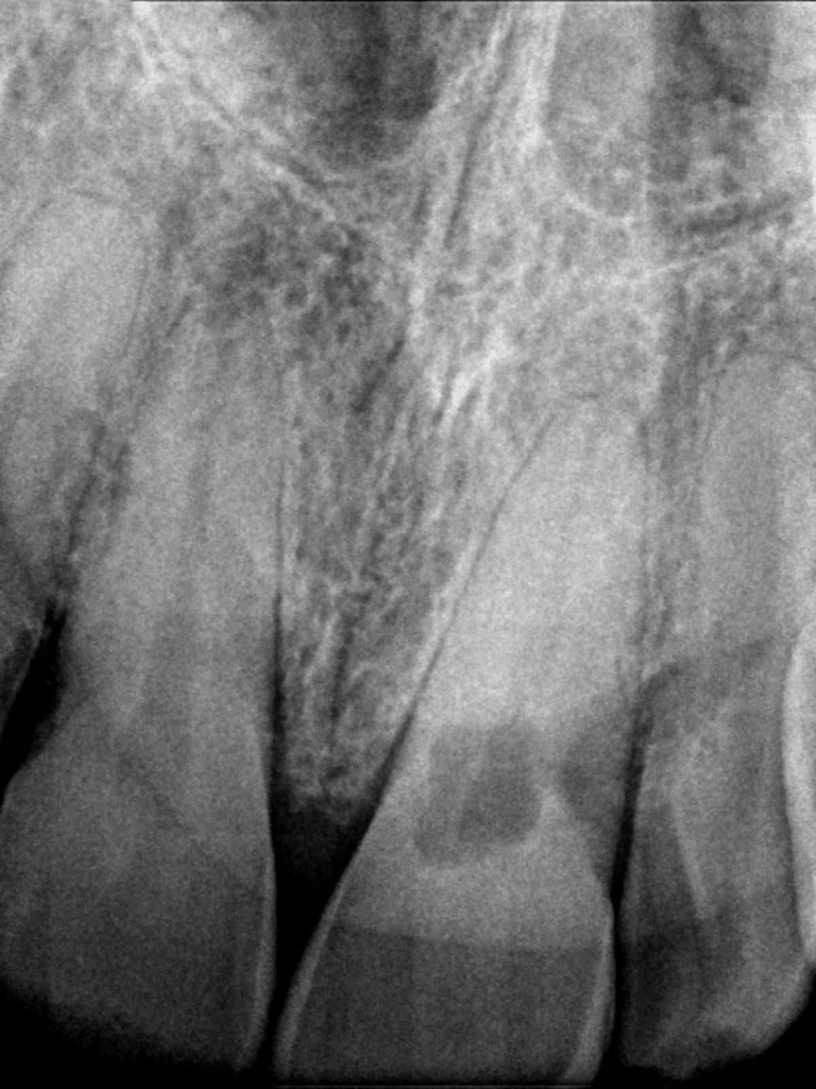 Conventional endodontic treatment with internal repair of resorptive ...