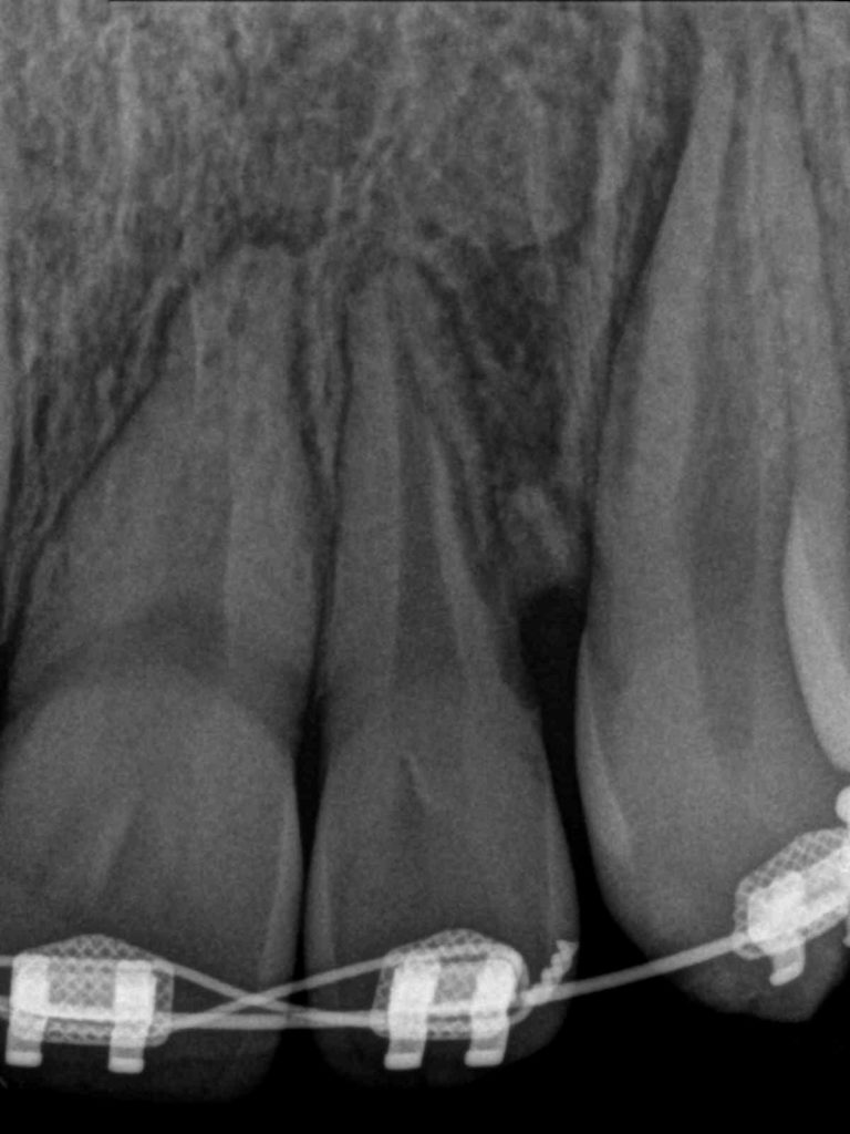 Orthodontic pressure/impacted tooth pressure resorption – Root Canal ...