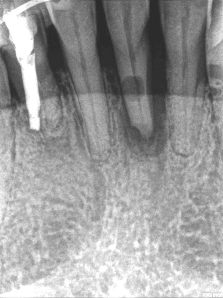 Conventional endodontic treatment including calcium hydroxide therapy ...
