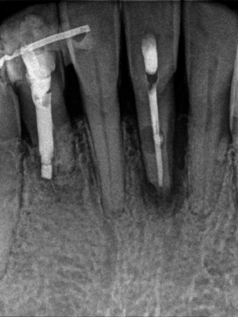 Conventional endodontic treatment including calcium hydroxide therapy ...