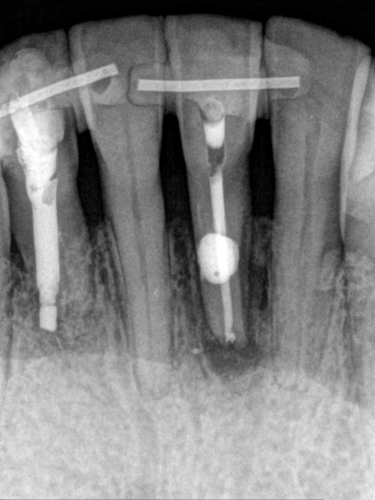 Conventional endodontic treatment including calcium hydroxide therapy ...