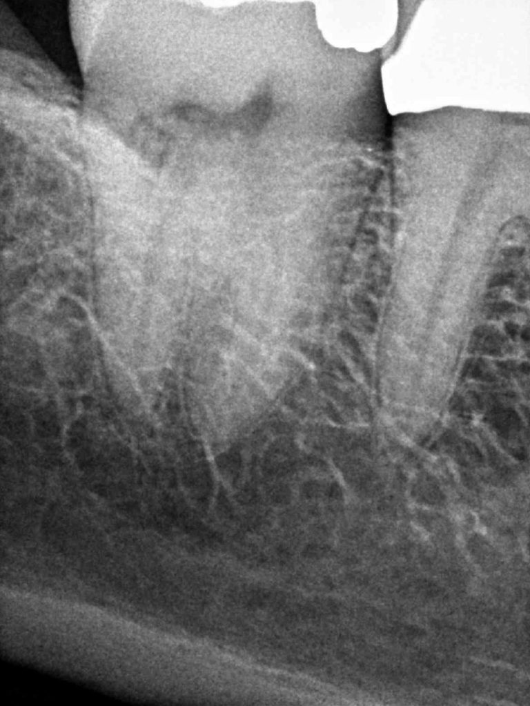 Pulpal infection root resorption (external): Arrested external ...