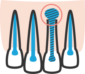 Apexification – Root Canal Specialty Associates