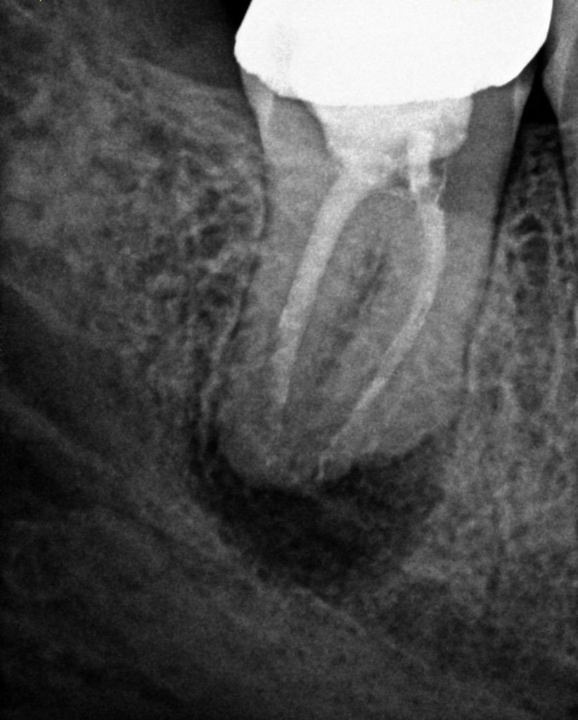 Endodontic Retreatment – Root Canal Specialty Associates