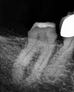 Highly curved tooth with great results – Root Canal Specialty Associates