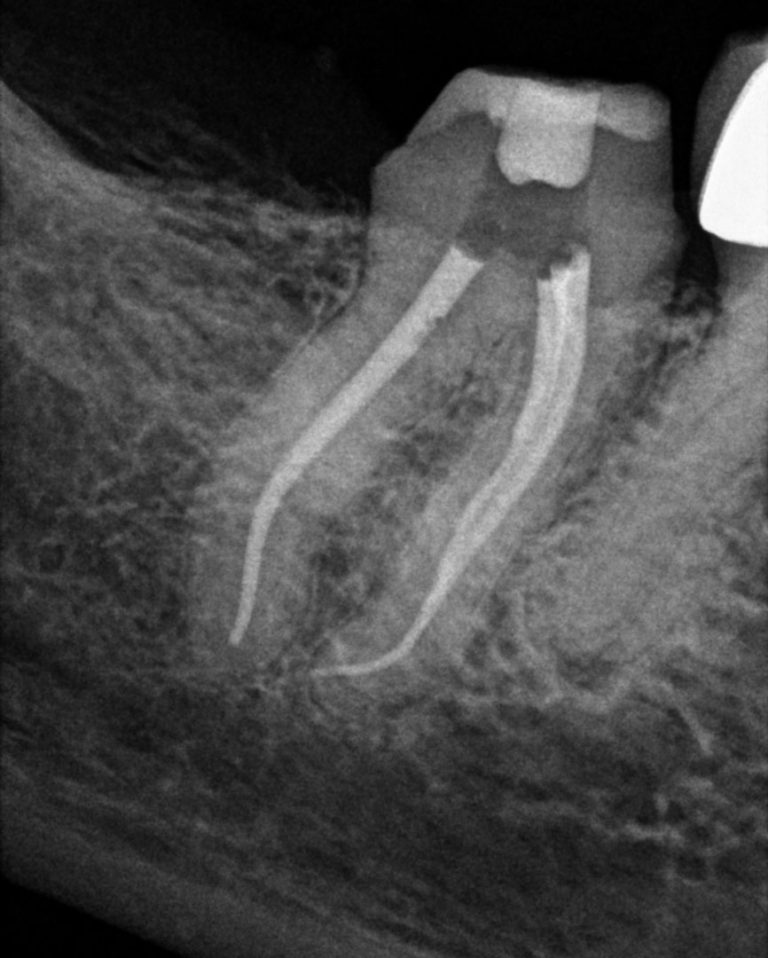 Highly curved tooth with great results – Root Canal Specialty Associates