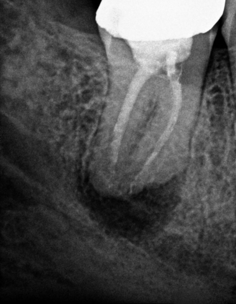 Running the Gamut: Trauma to Double Curvature – Root Canal Specialty ...